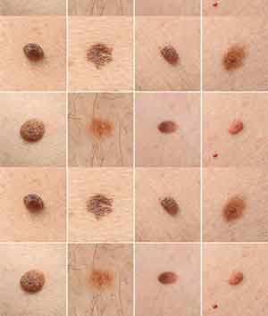 Benign Moles/Skin Tags/Lesions Removal – YHVH Medical Clinic